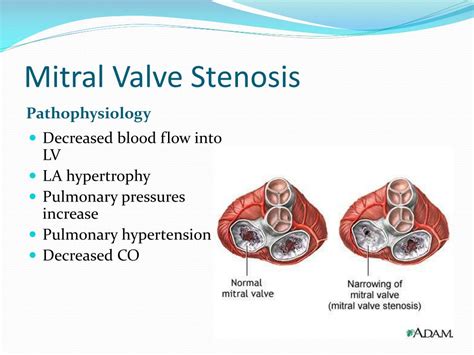 Mitral Valve Stenosis Pathophysiology