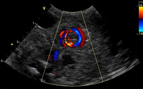 Whirlpool Sign On Ultrasound Imaging In A Preterm Infant With Suspected Malrotation Volvulus