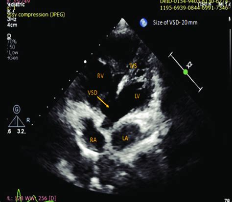 Modified Apical Five Chamber View Showing A Large Perimembranous Download Scientific Diagram