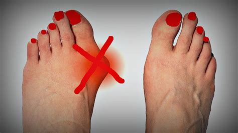 КОСТОЧКА НА НОГЕ исчезнет Возьми да приложи этот компресс в 2024 г Товары для здоровья