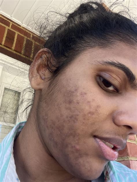 Hyperpigmentation Face Before And After