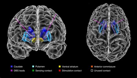 Ocd Brain Serotonin
