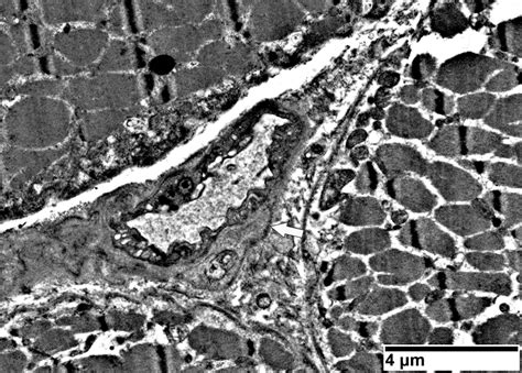 Small Vessel Vasculopathy