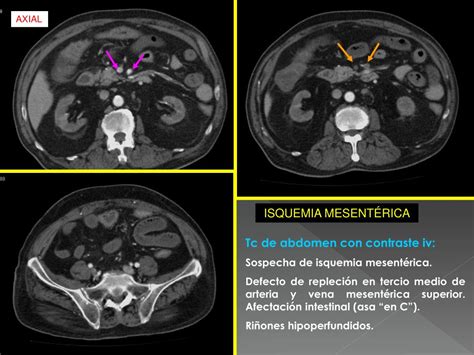 Ppt ClasificaciÓn Del Abdomen Agudo SegÚn EtiologÍa Y Mecanismo De