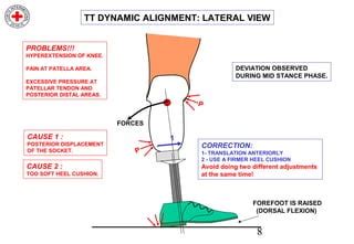 Transtibial Dynamic Alignment PPT