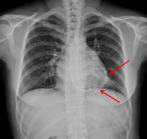 Eggshell Calcification