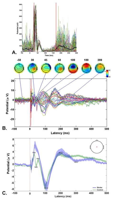 Abnormal EEG Responses To TMS During The Cortical Silent Period Are Associated With Hand