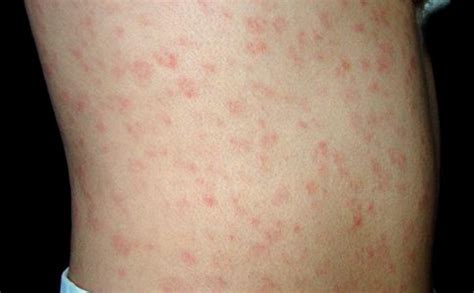 艾滋病图片艾滋病症状表现图片大全有来医生