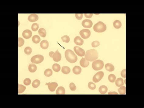 Ovalocyte
