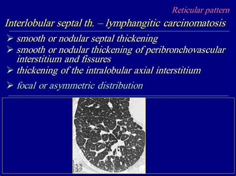 Reticular Pattern Pdf Lung And Respiratory Health Diseases And Conditions