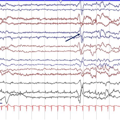 Abnormal Excessively Discontinuous Ceeg Background In A Term Neonate A Download Scientific