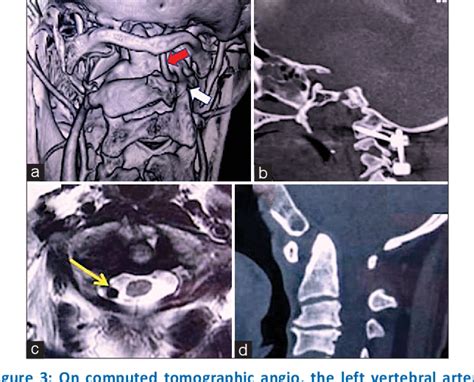 Figure 3 From C3 Segmental Vertebral Artery And Its Surgical