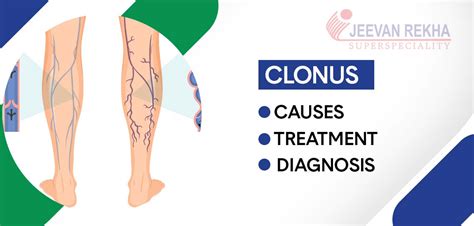 Clonus Causes Diagnosis And Treatment