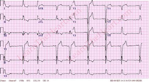 Left Bundle Branch Block ECG 4 LearntheHeart Com