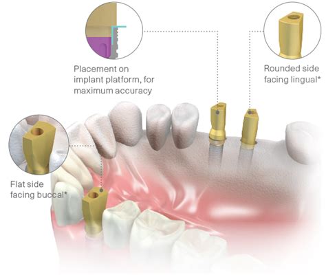 MIS Digital Restoration Multiple Teeth Abutment Level CONNECT System