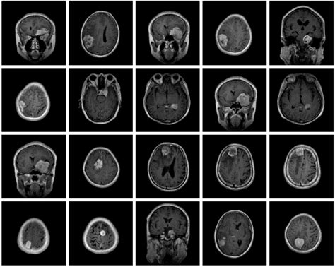 Refined Automatic Brain Tumor Classification Using Hybrid Convolutional Neural Networks For Mri