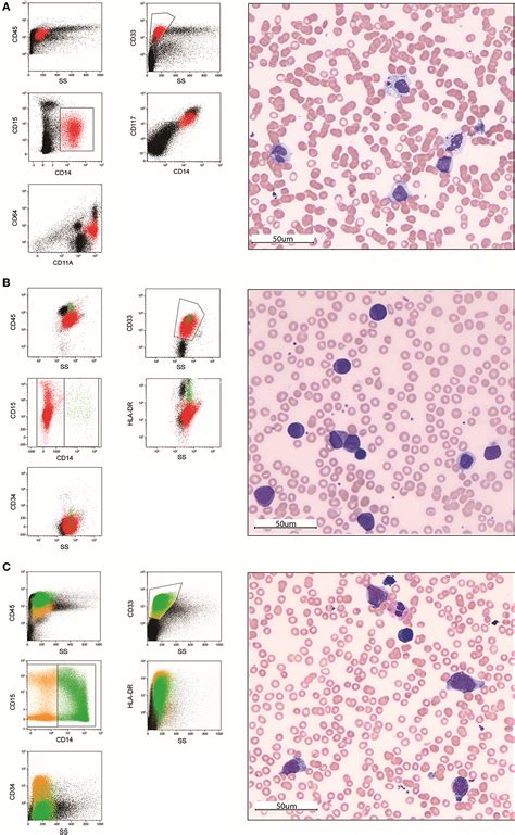 Leukemia Cells Differential