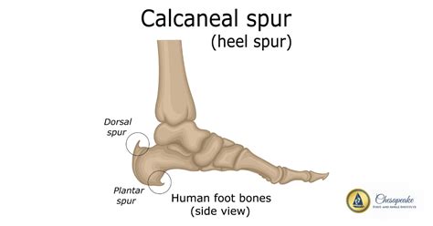 Bone Spurs On The Foot And When To See A Podiatrist Chesapeake Foot