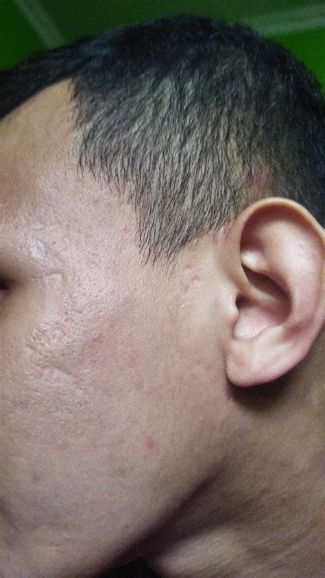 Heystetik Menghilangkan Bopeng Dengan Treatmet Subsisi Prp