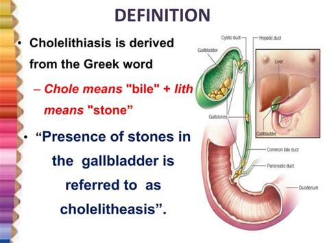 Cholelithiasis Pptx