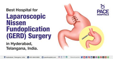 Best Laparoscopic Fundoplication Surgery In Hyderabad India