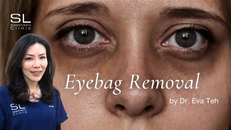 Laser Eye Bag Removal