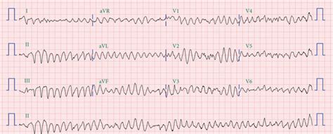 Polymorphic VT A Which Starts In A Pause Dependent Manner With A Download Scientific Diagram