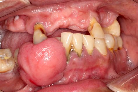 Peripheral Ossifying Fibroma