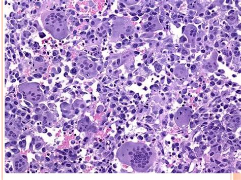 Cap Protocol Bladder Pptx