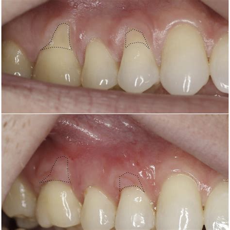 Soft Tissue Gum Graft Before And After Periodontist Nyc