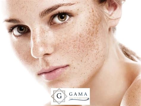 Пигментни петна по кожата Gama Cosmetic