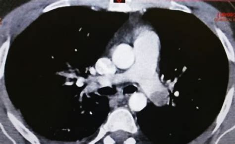 Case 3 Ct Angiogram Axial Section Showing Bilateral Proximal Download Scientific Diagram