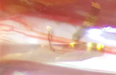 Regenerative Peripheral Neural Interface Xie Lab At Rice Ece