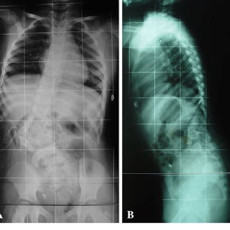 A Plain Radiography Shows Thoracolumbar Scoliosis And Multiple