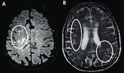 Showing Multiple Areas Of Hyperintensity In The Subcortical Areas On Download Scientific