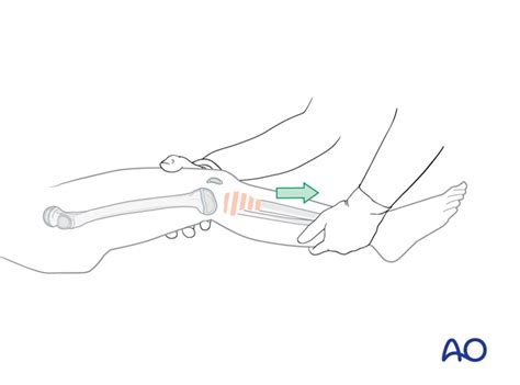 Closed Reduction K Wire Fixation For Complete Metaphyseal And Greenstick Fracture