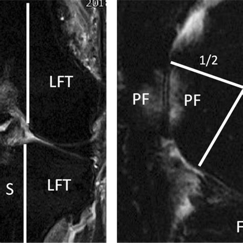The Kl Grading System To Assess The Severity Of Knee Oa Download Scientific Diagram