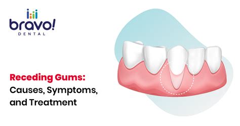 Receding Gums Causes Symptoms And Treatment Bravo Dental Dallas
