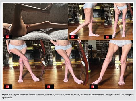 Fixation Of Pubic And Acetabular Pathologic Fracture With Curvafix Nail
