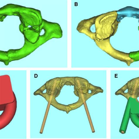 Ae Virtual Reduction Of The Fracture Fragments And Individualized 3d Download Scientific