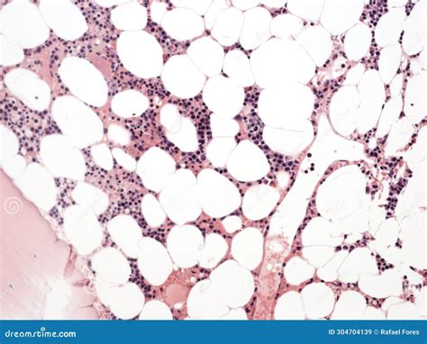 Paroxysmal Nocturnal Hemoglobinuria Stock Image Image Of Cells