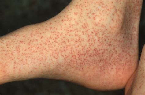 艾滋病图片艾滋病症状表现图片大全有来医生