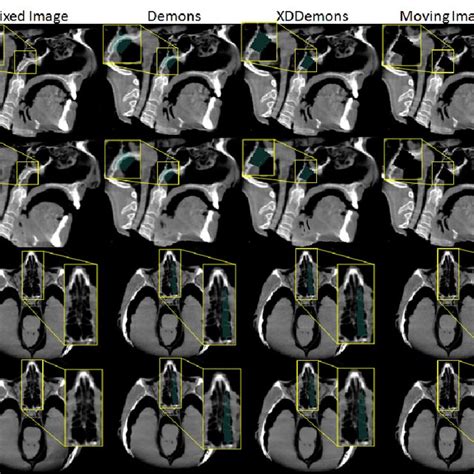 Illustration Of Registration Results For Conventional Demons And Download Scientific Diagram