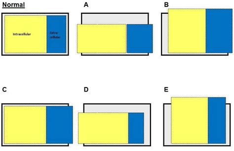 Volume Osmolarity Diagrams Question 3 A Patient With Hemophilia A Download Scientific