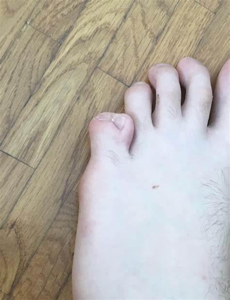 Infected Incision Pelvis Malformation From My 4th Hip Surgery R