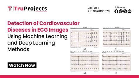 Detection Of Cardiovascular Diseases In Ecg Images Using Machine Learning And Deep Learning