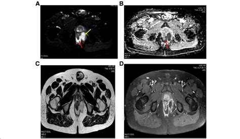Extra Sphincteric Perianal Abscess Grade 4 A Dwi Trace Image Showing Download Scientific