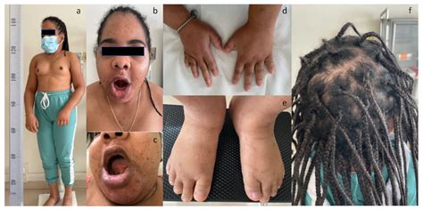 Complete Pseudo Anodontia In An Adult Woman With Pseudo