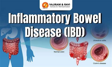 Inflammatory Bowel Disease Types Symptoms Causes Latest News