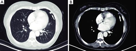 The Chest Ct Of Case 3 Showed A Lingular Nodular Lesion Arrow With